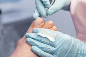 Uña Encarnada – Rehabilitacion El Consul – Clinica de Fisioterapia y ...